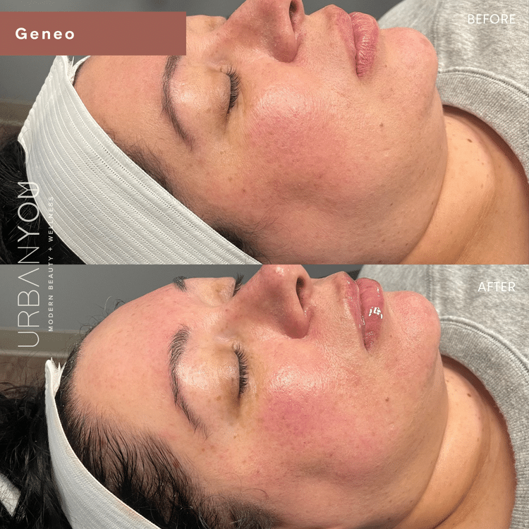 Glo2Facial Alpharetta GA - Youthtopia Med Spa